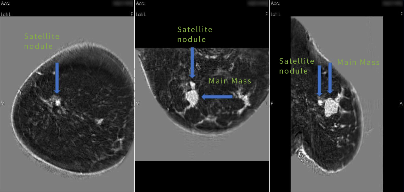 QT Ultrasound – Breast Imaging Modality Comparison Case Studies - QT ...