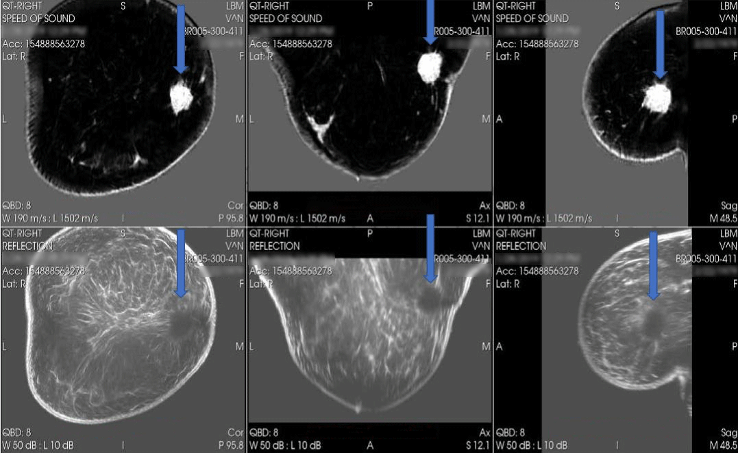 QT Ultrasound – Breast Imaging Modality Comparison Case Studies - QT ...