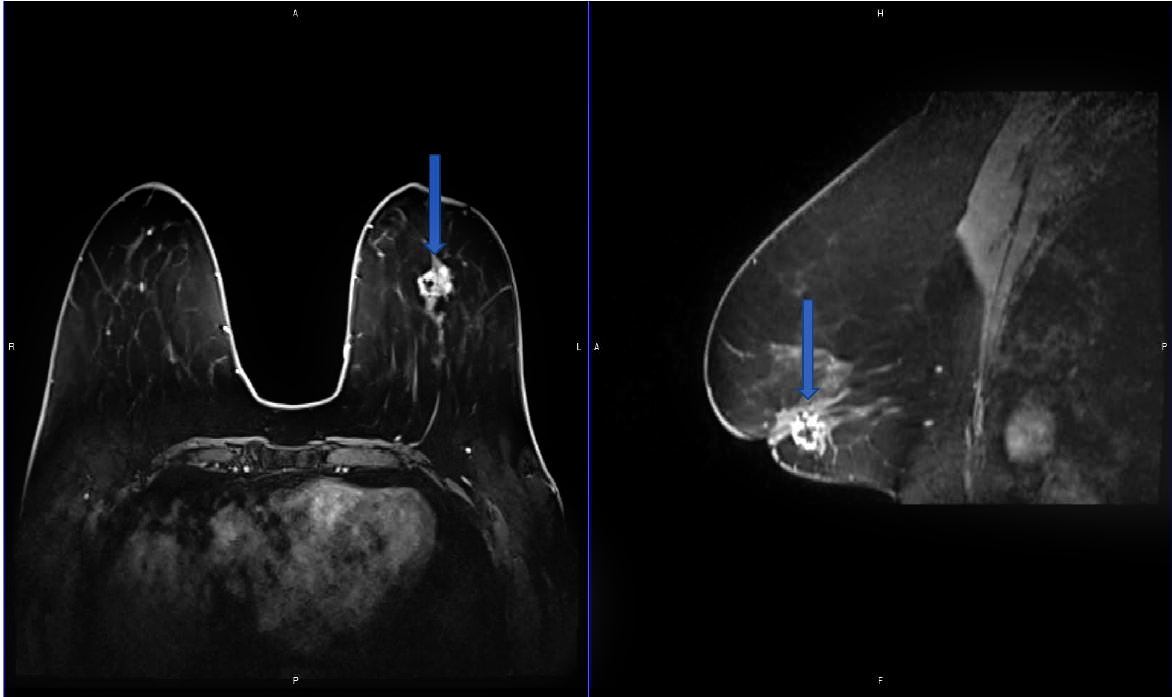 QT Ultrasound – Breast Imaging Modality Comparison Case Studies - QT ...
