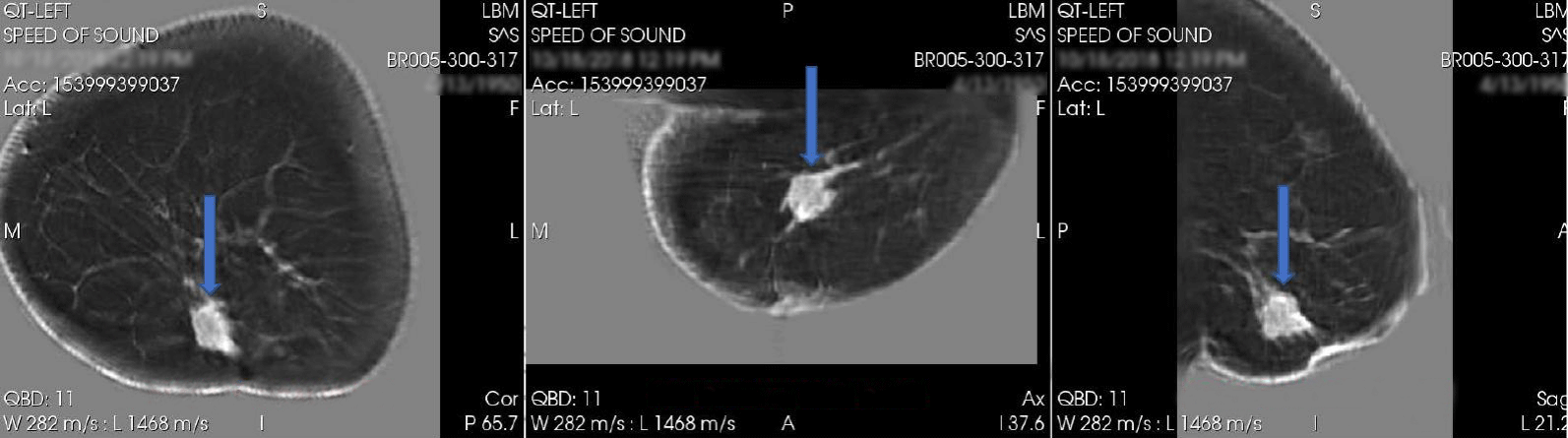 QT Ultrasound – Breast Imaging Modality Comparison Case Studies - QT ...