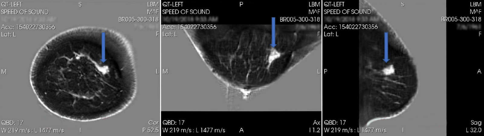 QT Ultrasound – Breast Imaging Modality Comparison Case Studies - QT ...