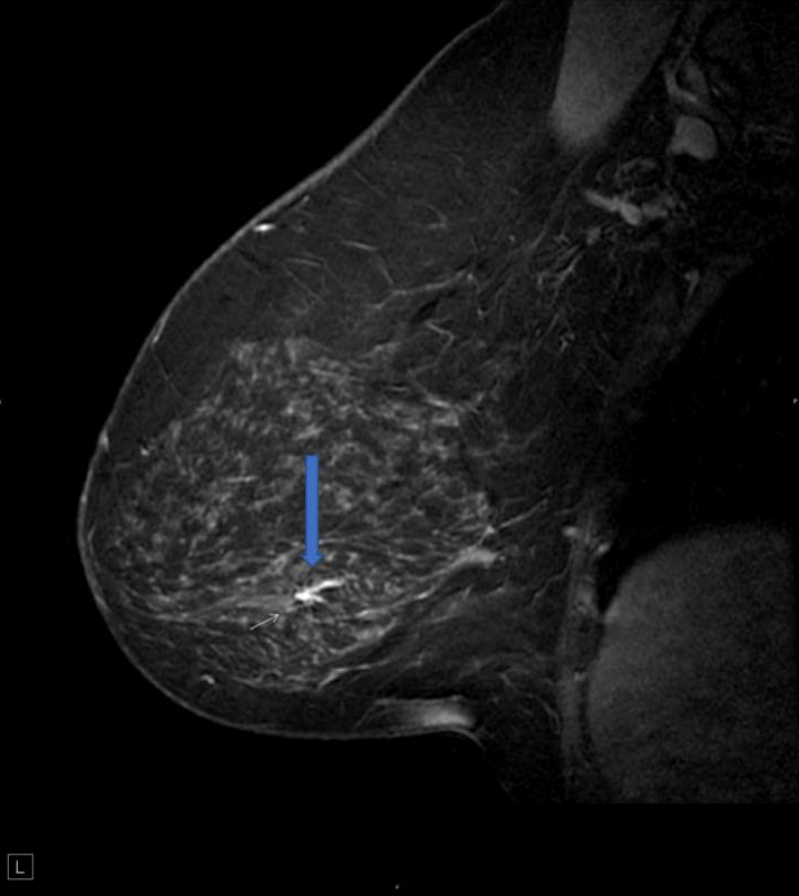 QT Ultrasound – Breast Imaging Modality Comparison Case Studies - QT ...